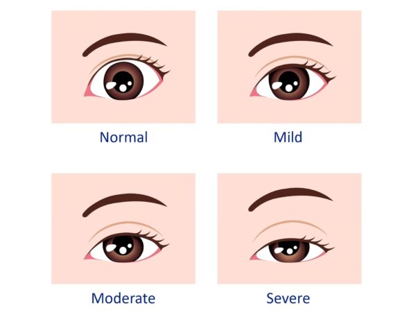 PTOSIS – R.R.Ayurvedic & Siddha Hospital